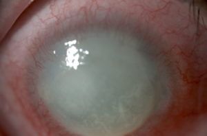 Six Of The Most Horrifying Parasites In Humans