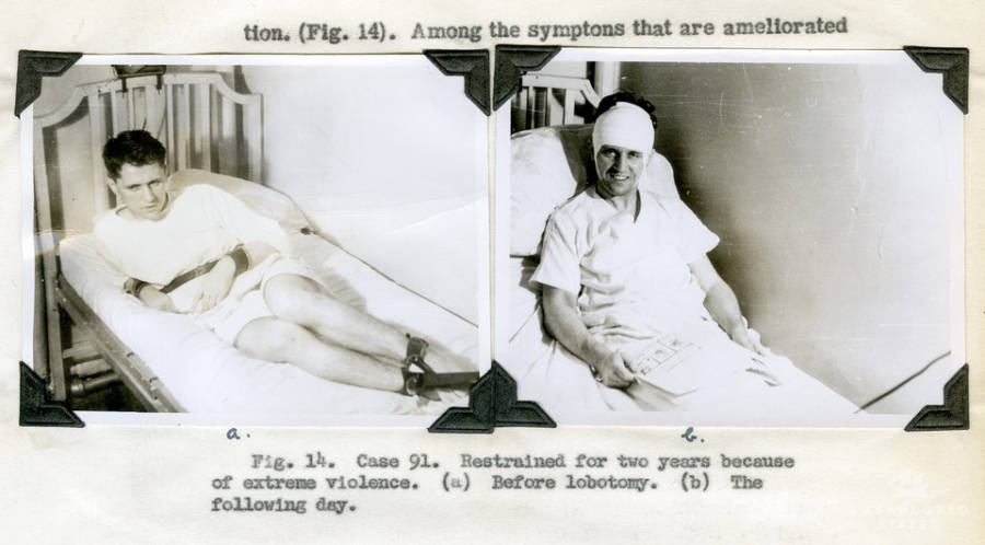 Walter Freeman And The Sordid History Of The Lobotomy