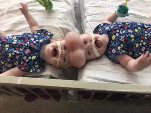 Baby Twins Conjoined At The Head Survive Difficult Surgery