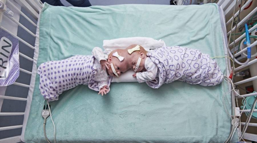 Inside The 72-Hour Surgical Odyssey To Separate Two Baby Twins ...