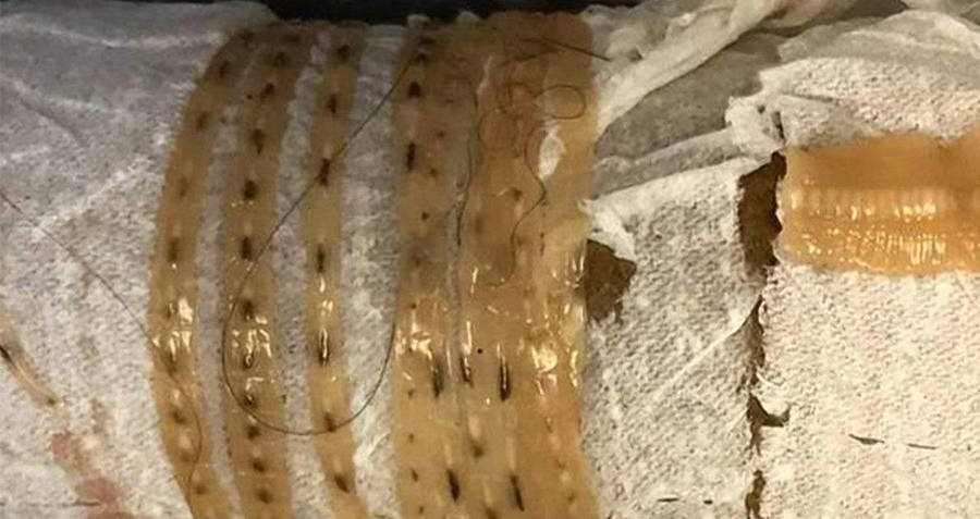 Sushi Lover Pulls Five And A Half Foot Tapeworm From Own Intestines Photo