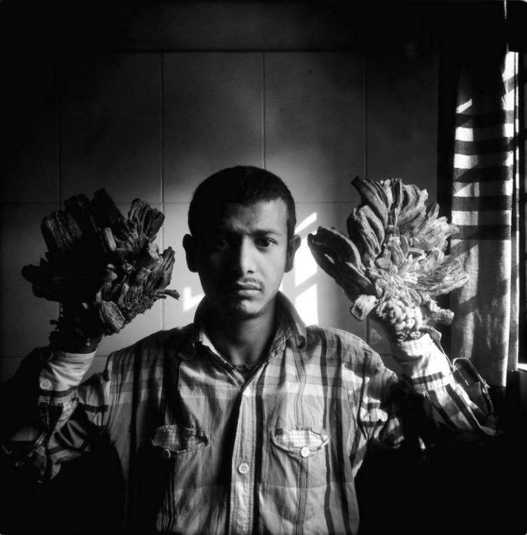 "Tree Man" Syndrome Turns People Into Living, Breathing Pieces Of Bark