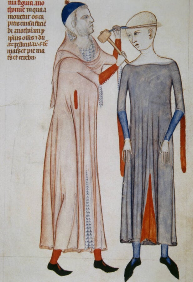 Trepanation: The Ancient Surgery Of Drilling A Hole Into The Skull