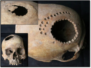 Trepanation: The Ancient Surgery Of Drilling A Hole Into The Skull