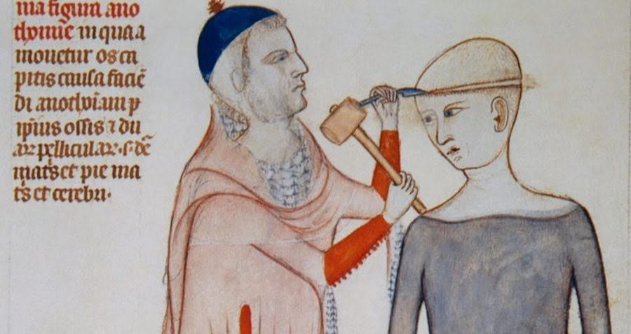 Trepanation: The Ancient Surgery Of Drilling A Hole Into The Skull