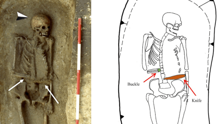 Medieval Italian Warrior Used A Bladed Weapon To Replace His Amputated Hand