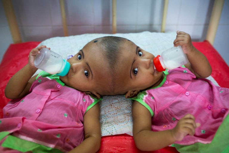 Conjoined Twins: What It's Like To Be Literally Joined At The Hip