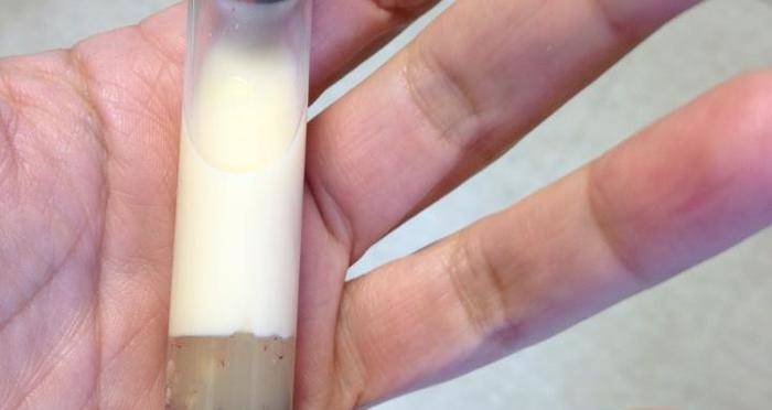 This Man's Blood Was So Fatty It Turned Thick, White, And Milky