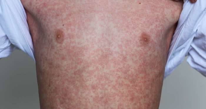 Vancouver Dad Who Caused Measles Outbreak Didn't Vaccinate Kids