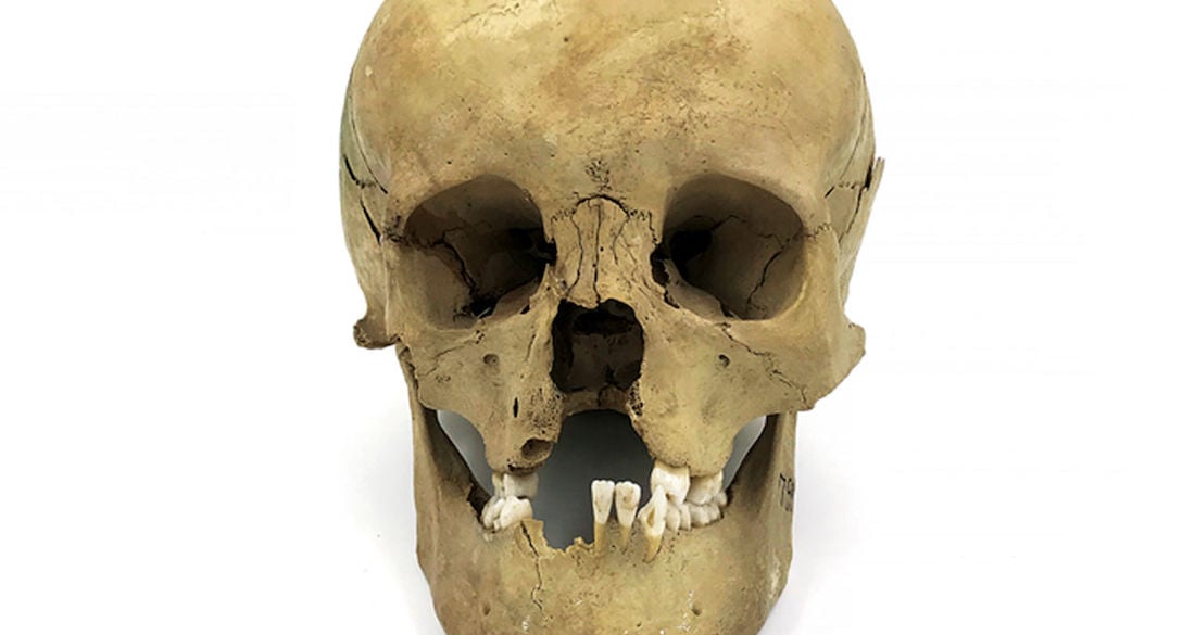 Rare Conditions Such As Dwarfism May Have Been Revered By Ancient People