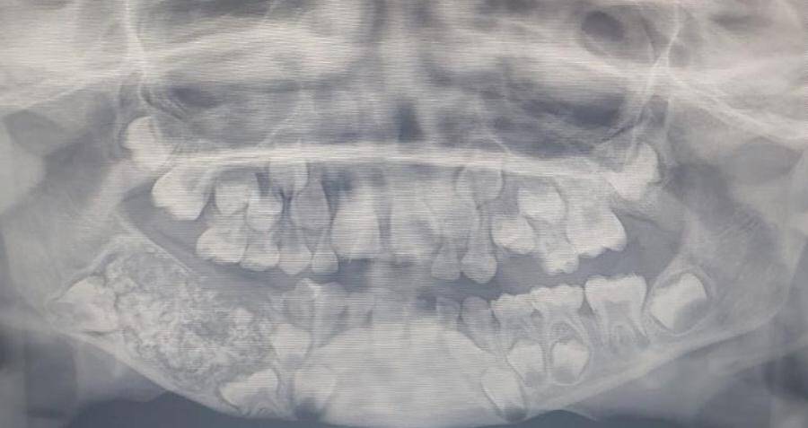 Doctors Find 526 Teeth In Boy's Mouth After Complaints Of Jaw Pain