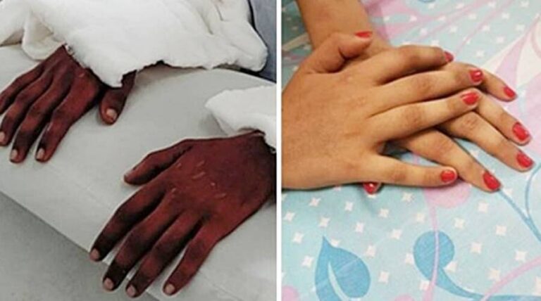 Patient's New Hand Transplants Unexpectedly Change Skin Tone