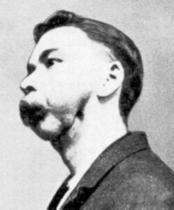 Phossy Jaw: How Toxic Phosphorous Disfigured 19th-Century Matchmakers