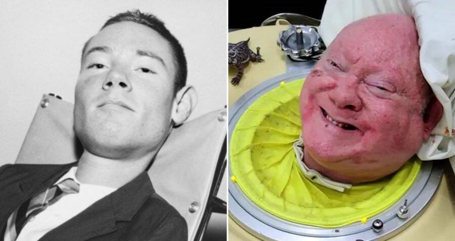 Paul Alexander, The Man Who Lived In An Iron Lung For 72 Years