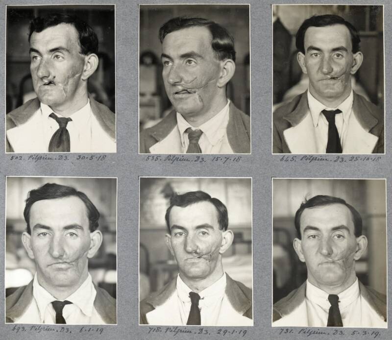 Harold Gillies: The Surgeon Who Rebuilt The Faces Of WW1 Veterans