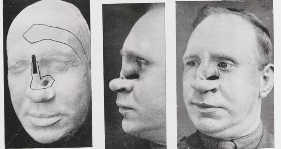 Harold Gillies: The Surgeon Who Rebuilt The Faces Of WW1 Veterans