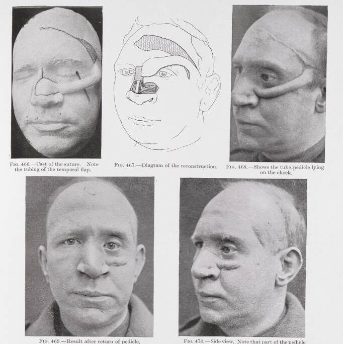 Harold Gillies: The Surgeon Who Rebuilt The Faces Of WW1 Veterans