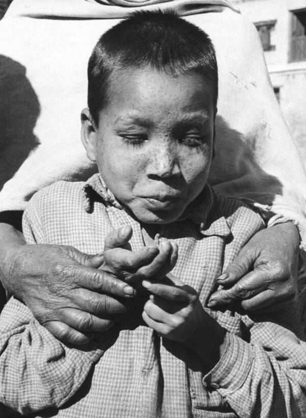 Smallpox Pictures That Reveal The Disease's Devastating History