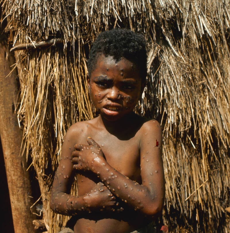 Smallpox Pictures That Reveal The Disease's Devastating History