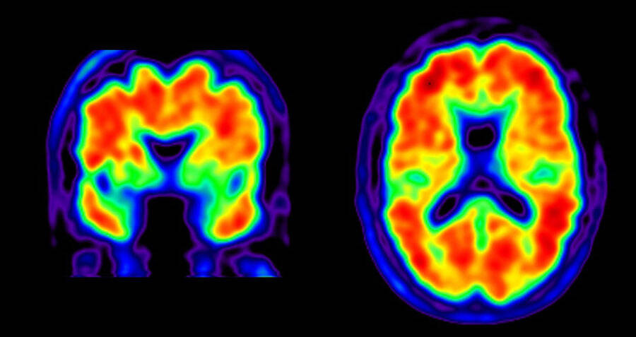 Man With Alzheimer's Experiences Real Life 'Groundhog Day'