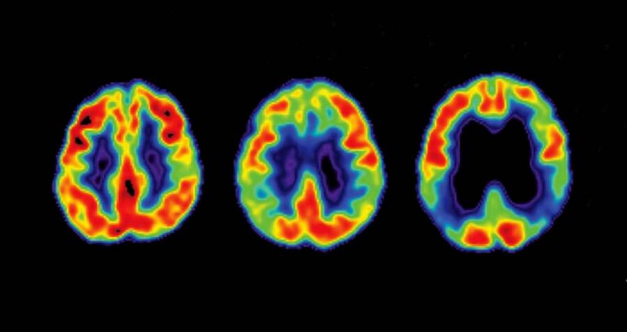 Man With Alzheimer's Experiences Real Life 'Groundhog Day'