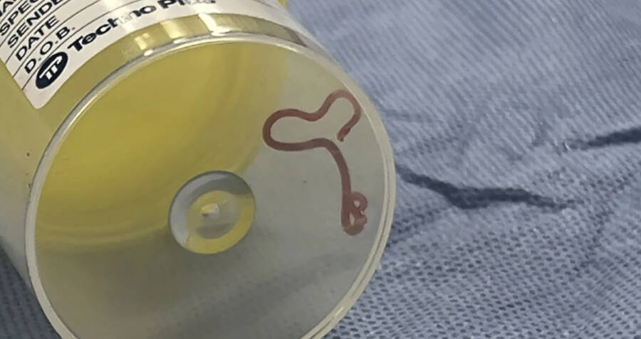 Doctors Found A Three-Inch Worm Living In A Woman's Brain