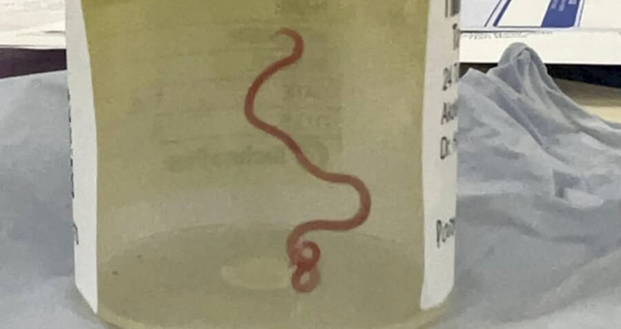 Doctors Found A Three-Inch Worm Living In A Woman's Brain