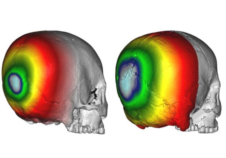 Did The Hirota People Of Japan Intentionally Deform Their Skulls?