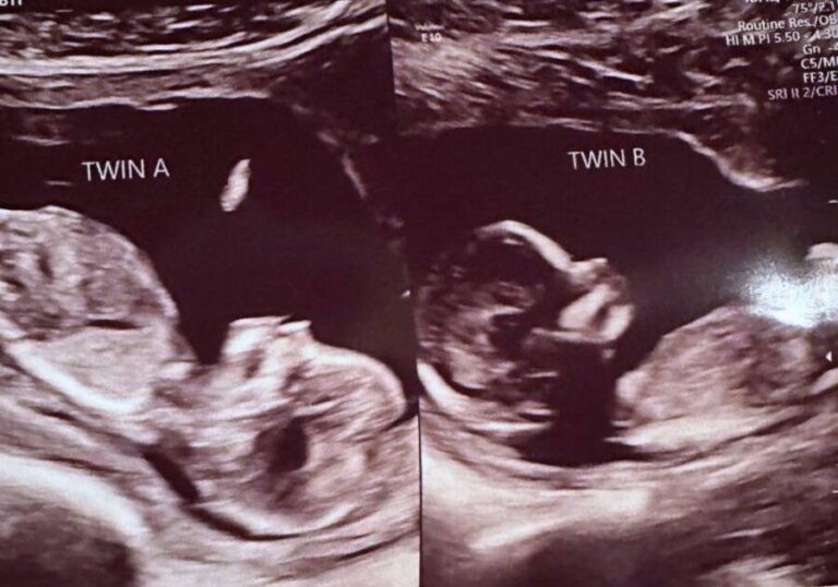 Alabama Woman With Two Uteruses Is Pregnant In Both Of Them