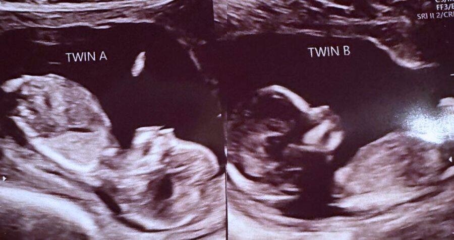 Alabama Woman With Two Uteruses Is Pregnant In Both Of Them