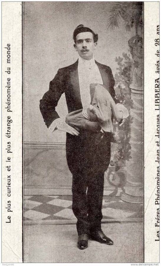 Who Was Jean-Jacques Libbera, The 'Double-Bodied Man'?