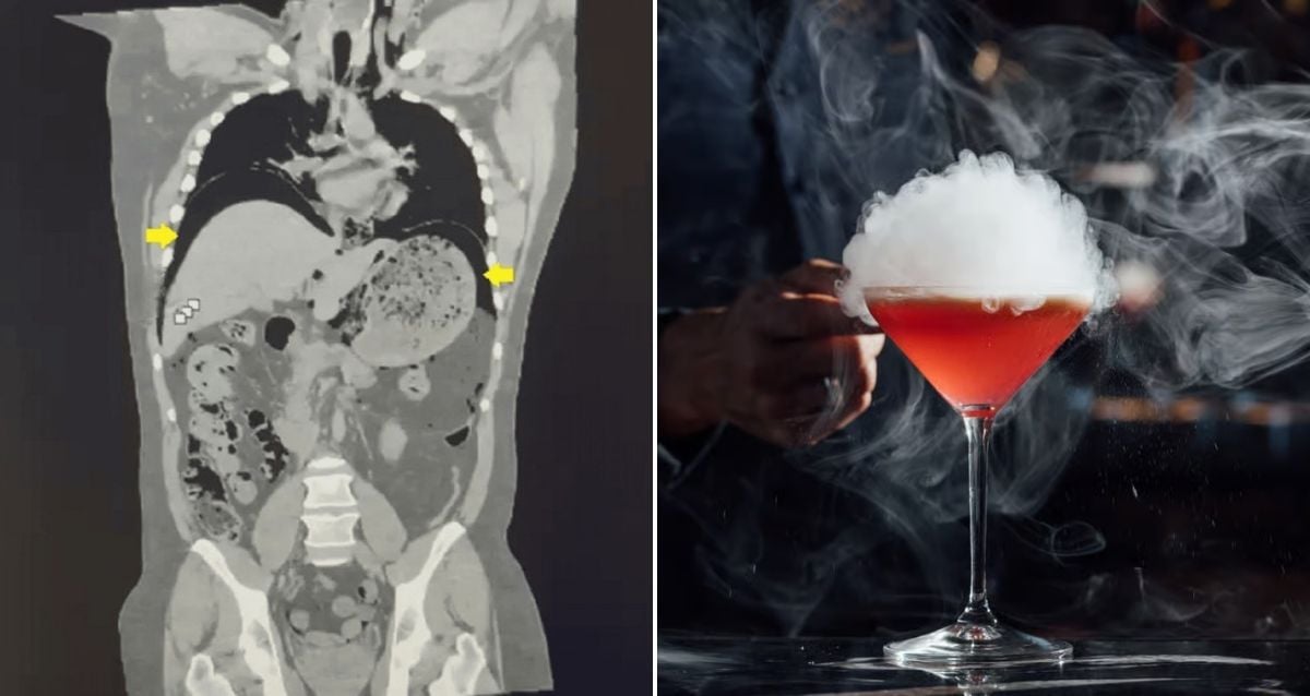 Liquid Nitrogen-Infused Cocktail Ruptures Man's Stomach